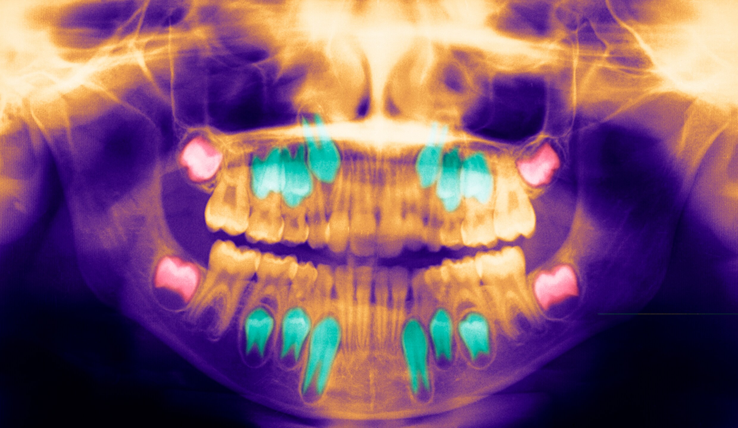 Meer slechte gebitten bij Amsterdamse kinderen: ‘Bepalen thuis vaak ...