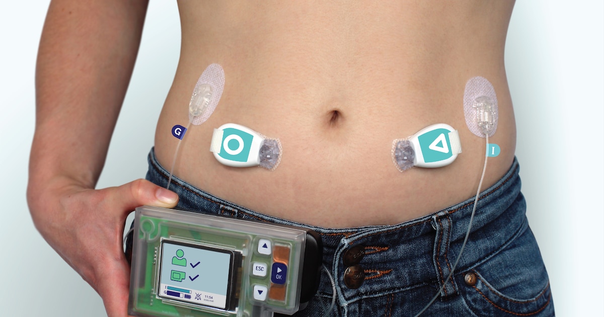 Diabetespatiënt ontwikkelt kunstmatige alvleesklier die insulinespuit ...