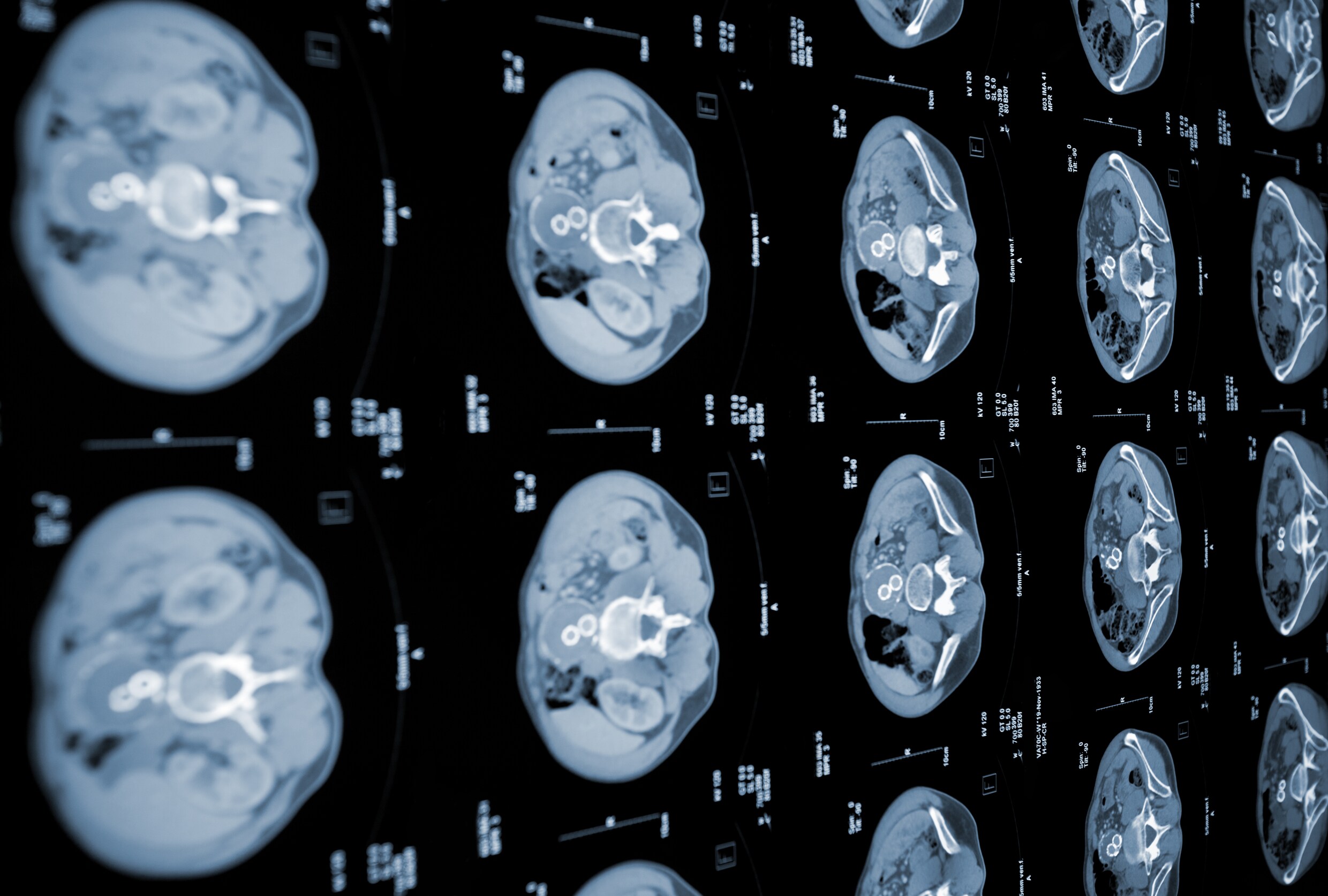 Tienduizenden kankerdiagnoses méér per jaar: ‘Stoppen met roken heeft ...